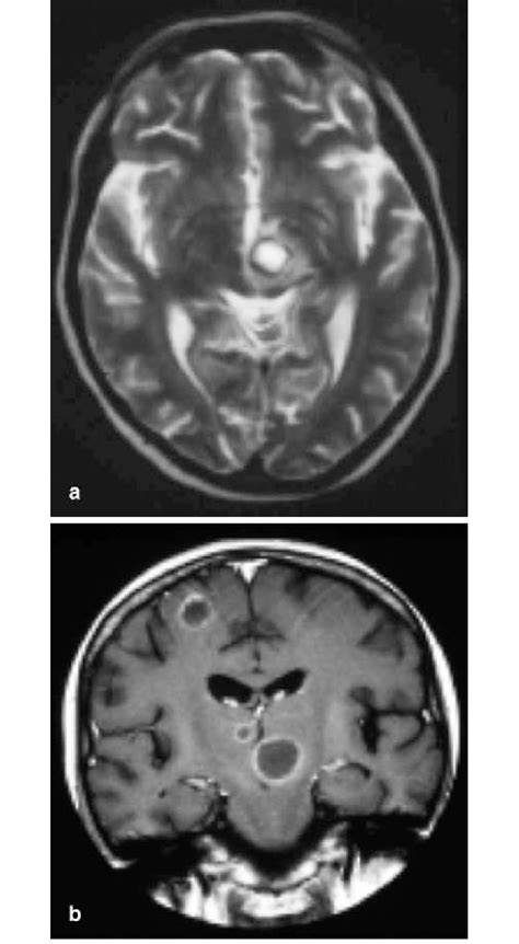 Differential Diagnosis Of Caseating Granuloma At Carlos Huguley Blog