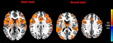 Task Specific Brain Activations At T0 Pooling The Two Groups The Group