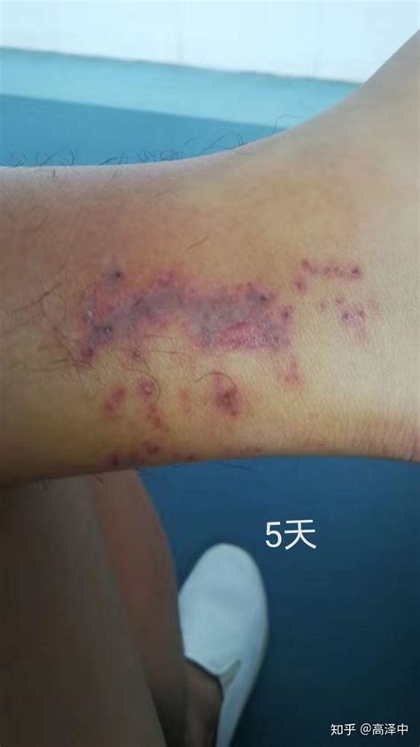 被水母咬伤之后 知乎