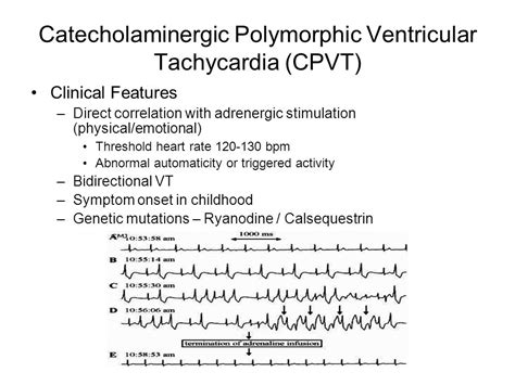 Normal Heart Vt Ppt Video Online Download