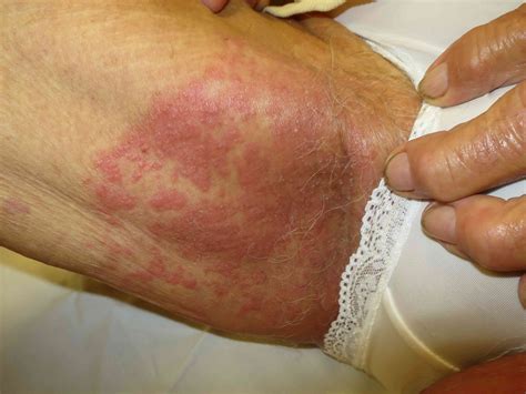 Candidiasis Skin Folds