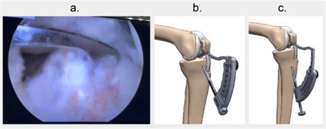 The Sironix ACL Jig A Solution For Tibial Tunnel Angle And Length Auctores