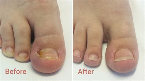 Unghia Incarnata The Ingrown Toenail Before And After Youtube