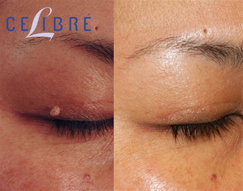 Safe And Effective Skin Tag Removal Celibre Medical