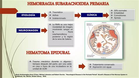 Hemorragia Intraventricular Pptx