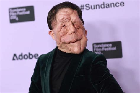 Adam Pearson Speaks Out Against How Actors With Disabilities Are Only Offered Certain Types Of
