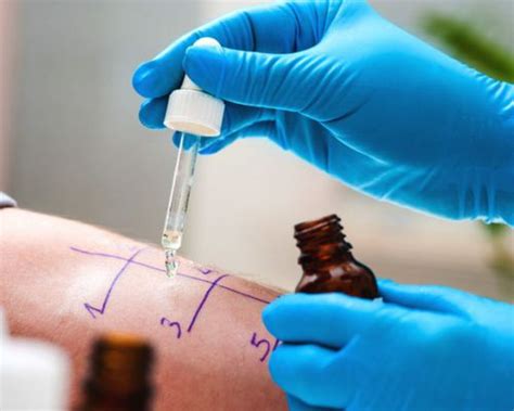 Rast Test Allergy Test At Home Starts Rs 150 Medintu