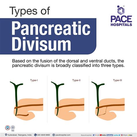 The Pancreas Divisum Pace Hospitals Hitech City