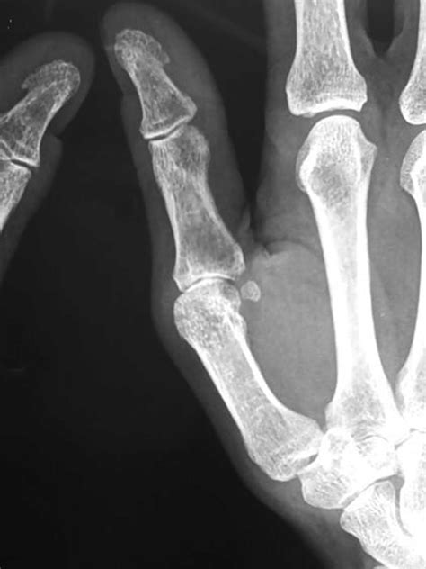 Radiological Signs Of Subluxation Of First Mcp Joint After Chronic Ucl