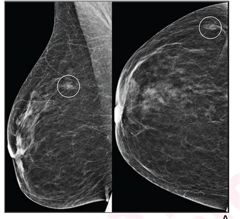 Large Mammography Study Shows Mixed Results With Ai In Breast Cancer