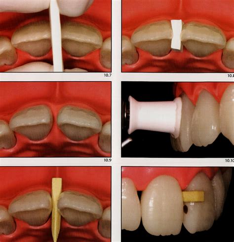 Class Iii Composite Restoration “ Strictly Proximal Access “ Dental