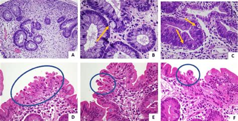 A B C Autoimmune Enteropathy With Crypt Atrophy And Hyperplasia