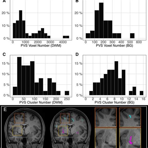 Distribution Of The Manually Delineated Pvs Voxel Load In The Deep