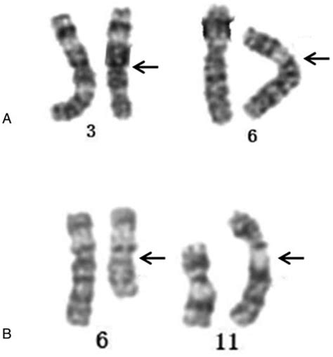 Expectant Management And Live Birth Outcomes For Male Balanced Translocation Carriers Two Case