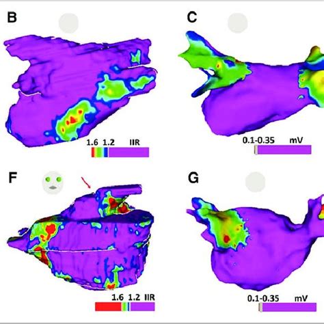 Comparison Of Atrial Substrate On Electroanatomic Voltage Map And Late Download Scientific