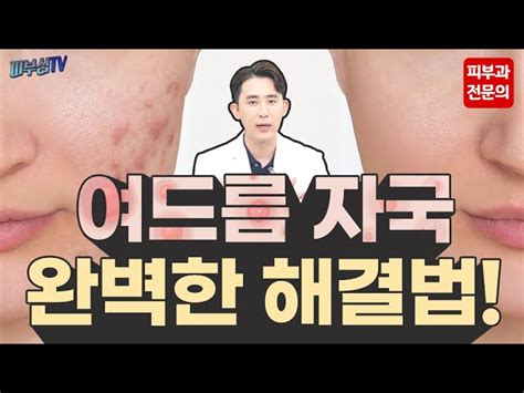 여드름 자국 완벽한 해결법 피부과전문의 피부심