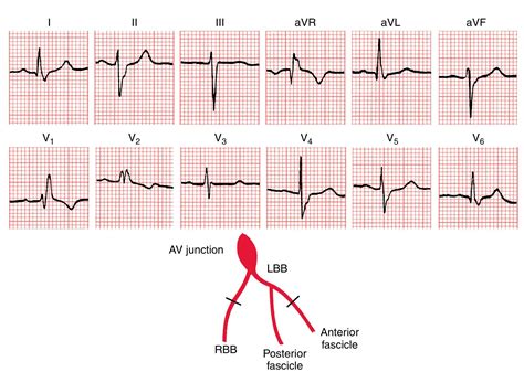 Bifascicular Block Right Bundle Branch Block With Left