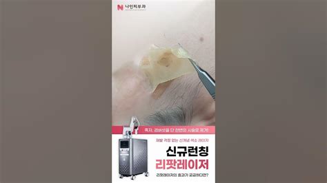 리팟레이저 나인피부과 흑자 검버섯 단 한번의 시술로 치료 가능 Youtube