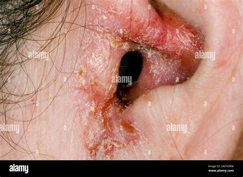 Close Up Of The Infected Outer Ear Otitis Externa In A 71 Year Old