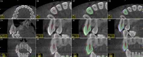 Segmentation Sequence In The Itk Snap Interface For The Maxillary