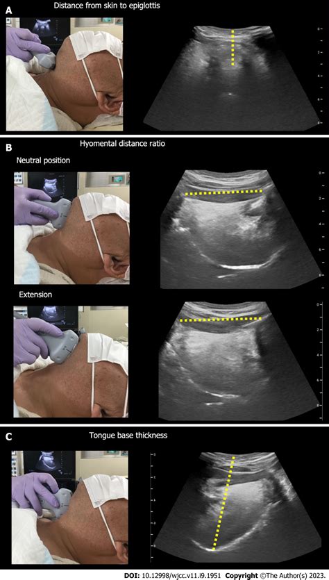 Airway Ultrasound For Patients Anticipated To Have A Difficult Airway