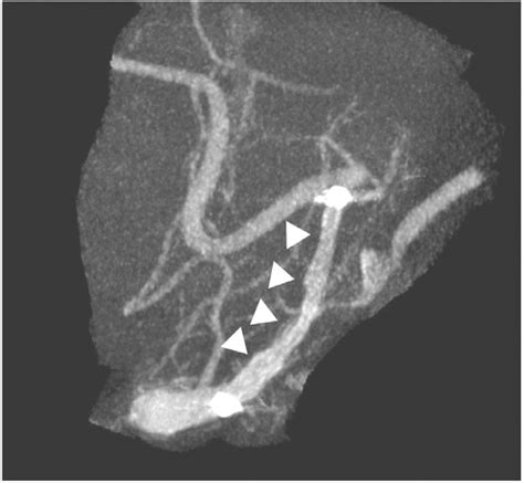 Cone Beam Ct After Stent Placement The Stent Was Placed In The Download Scientific Diagram