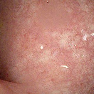 Colonoscopy Revealed Erythema And A Decreased Vascular Pattern Download Scientific Diagram
