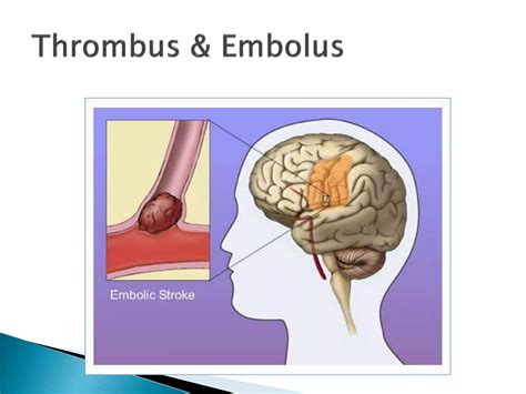 Arterial And Venous Embolectomy Pptx
