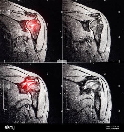 Mri Shoulder Bursitis