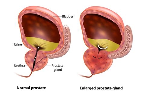 Benign Prostatic Hyperplasia Mens Health A Z Canadian Mens Health