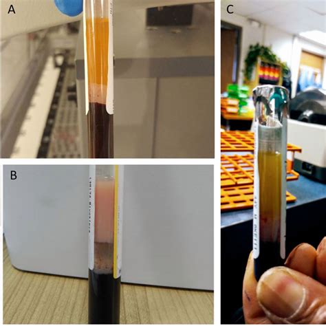 Pseudohyponatraemia Secondary To Hyperlipidaemia In Obstructive Jaundice Bmj Case Reports