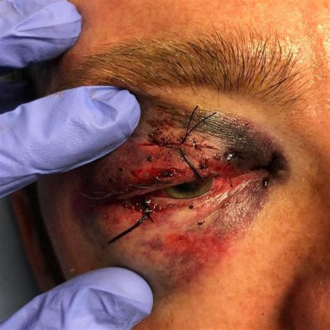 Optometry Case This Gentleman Received 3 Lid Lacerations Facebook