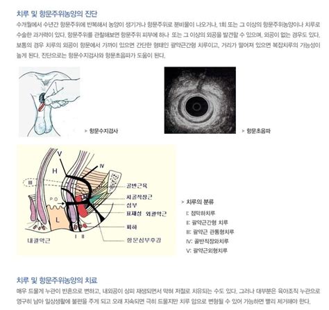 치루 및 항문주위농양 대장항문전문 강남송도외과