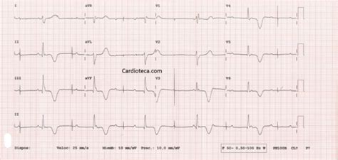 Curso Ecg Flutter Auricular Común