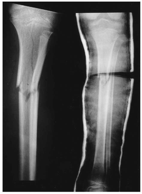 Tibia And Fibula Fracture Garetwarehouse