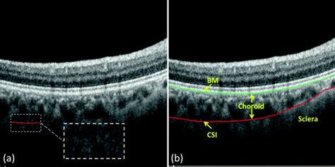 Illustration Of A Sample Oct B Scan And Its Choroid Layer Boundaries