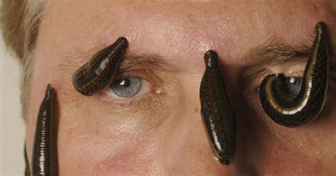 Leeches Are Bizarrely Good For Human Health 7 Incredible Benefits