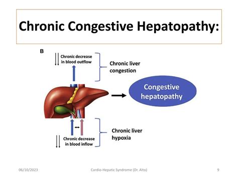 Ppt Cardio Hepatic Syndrome Powerpoint Presentation Free Download