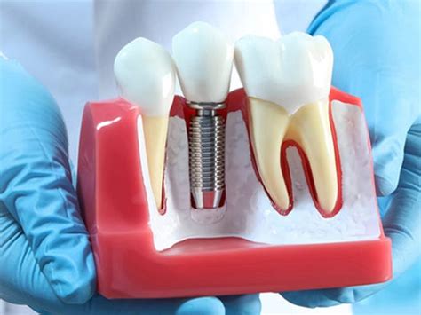 Solving The Challenge Of Limited Bone Density For Dental Implant