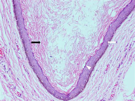 Sebaceous Cyst Histology At Spencer Erlikilyika Blog Sebaceous Cyst Histology At Spencer Erlikilyika Blog