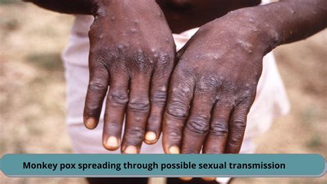 Monkey Pox Spreading Through Possible Sexual Transmission