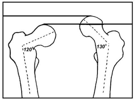 Managing Limb Length Discrepancies Human Locomotion