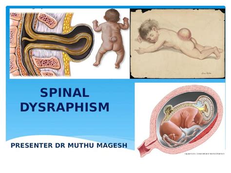 Pptx Imaging Of Spinal Dysraphism Dokumentips