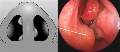 Potd Nasal Septal Hematomas — Maimonides Emergency Medicine Residency