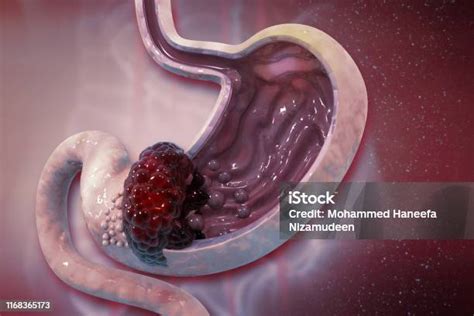 위암 암 공격 세포 위 질환 개념 3d 일러스트레이션 건강관리와 의술에 대한 스톡 사진 및 기타 이미지 건강관리와 의술 경련 궤양 Istock