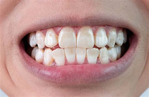 Enamel Hypoplasia Treatment Of Enamel Defects Hypoplasia And