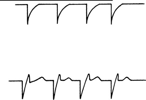 Follow Up Of The Patient Who Has Received A Pacemaker Thoracic Key