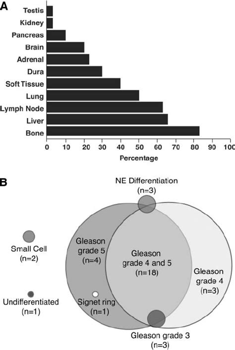 A Distribution Of Hormone Refractory Prostate Cancer Metastasis From