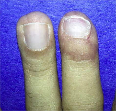 Eponychial Flap Refinement For The Treatment Of “hook Nail” Deformity