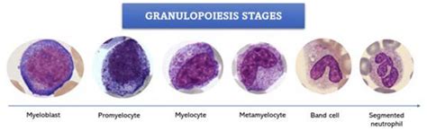 Immature Granulocytes High